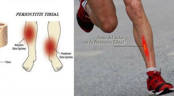 Corredor antes que runner - La periostitis - 22/10/17