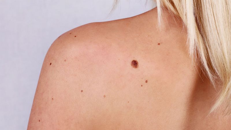 Día Mundial Del Melanoma Hay Que Mirarse Mucho La Piel Es Un Tipo De