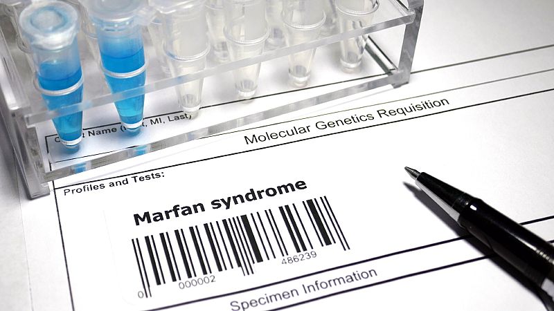Síndrome de Marfan: un diagnóstico inesperado
