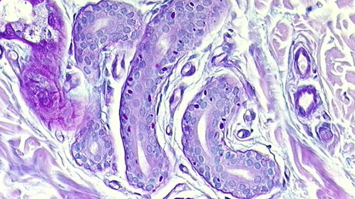 Enfermedad de Lafora, una forma rara de epilepsia - RTVE.es