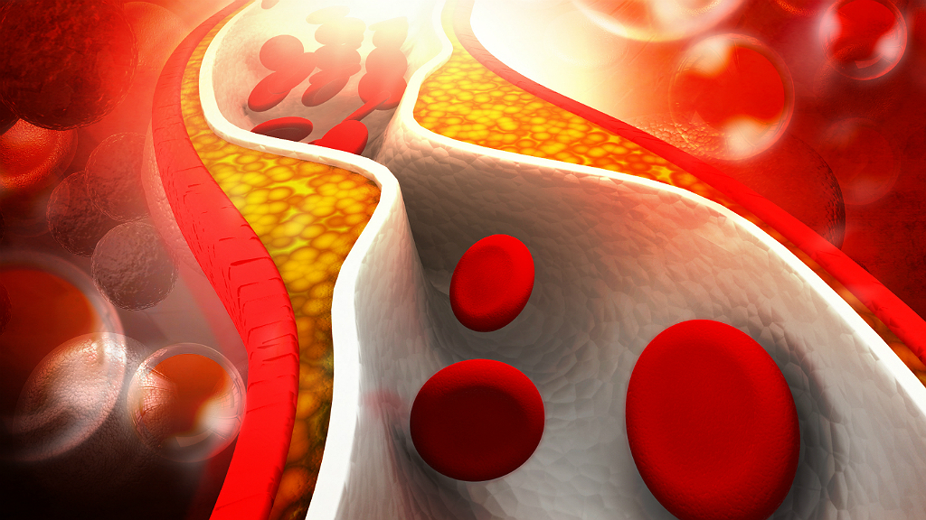 La arteriosclerosis, una enfermedad prevenible - RTVE.es