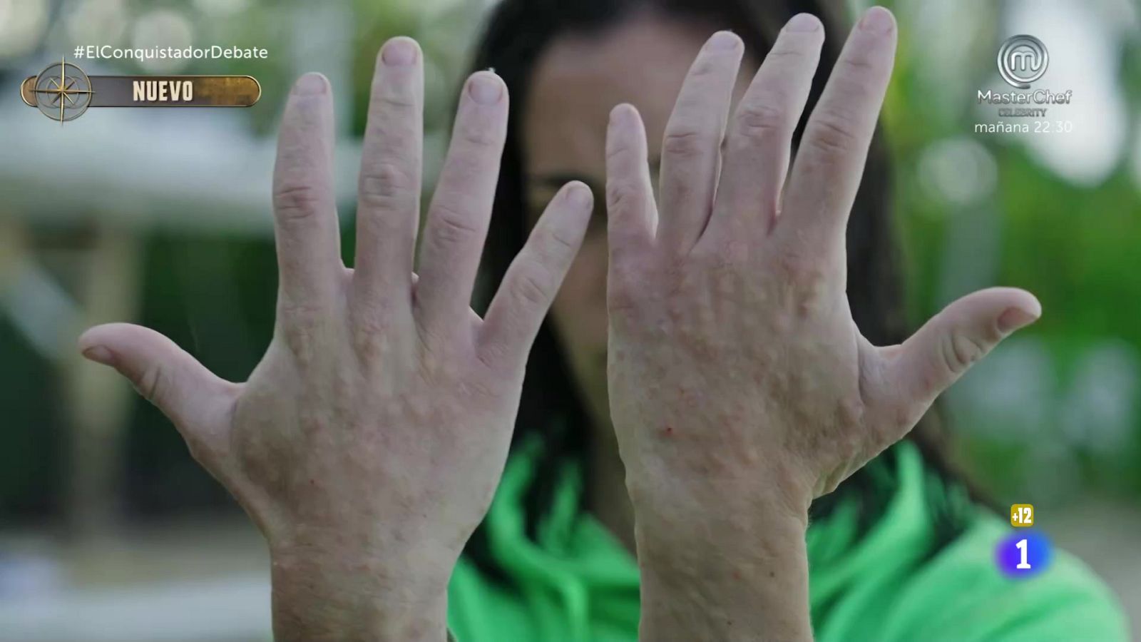 El Conquistador | Las terribles picaduras de mosquito